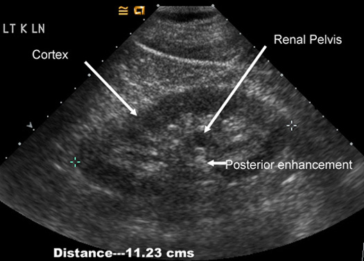 Sonographically determined kidney measurements are better able to ...